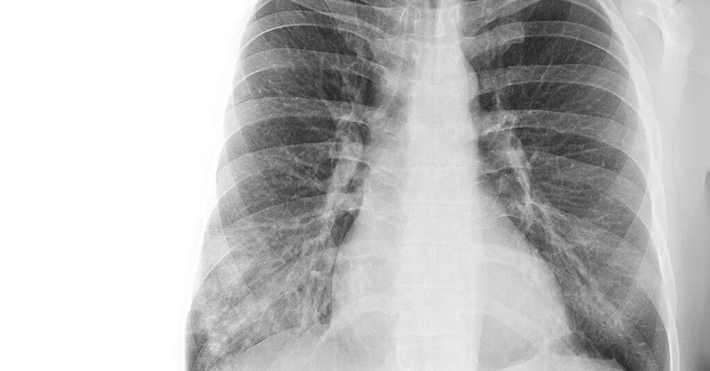 Duodecim Harjoittele keuhkokuvien tulkintaa Oppiportin uutuuskursseilla